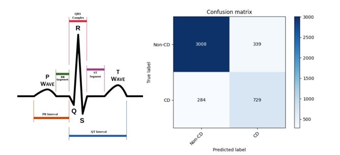 ResNET CNN for Heart Disease Classification | Yaxuan Zhang